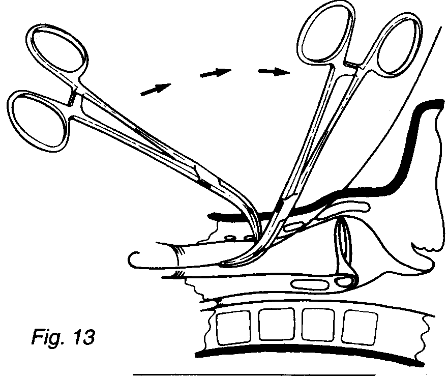 Percutaneous Dilatational Tracheostomy ( PCDT ) – Anesthesiaworld