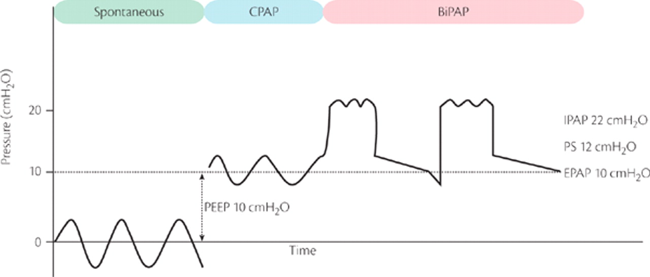 Non Invasive Ventilation – Anesthesiaworld